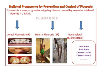 Fluorosis