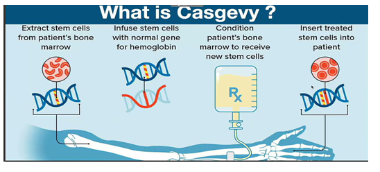 First Gene Therapies to Treat Patients with Sickle Cell Disease - GS SCORE